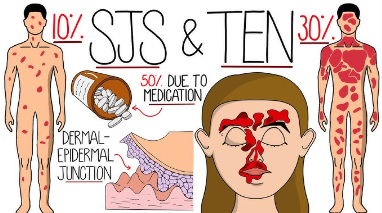 HỘI CHỨNG STEVENS-JOHNSON